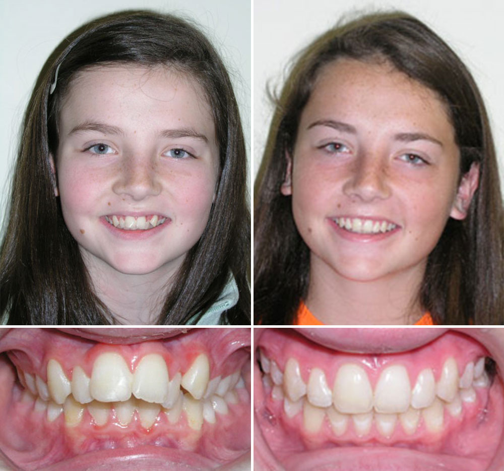 Orthodontic Before & Afters | Braces Willston | Champlain Orthodontics